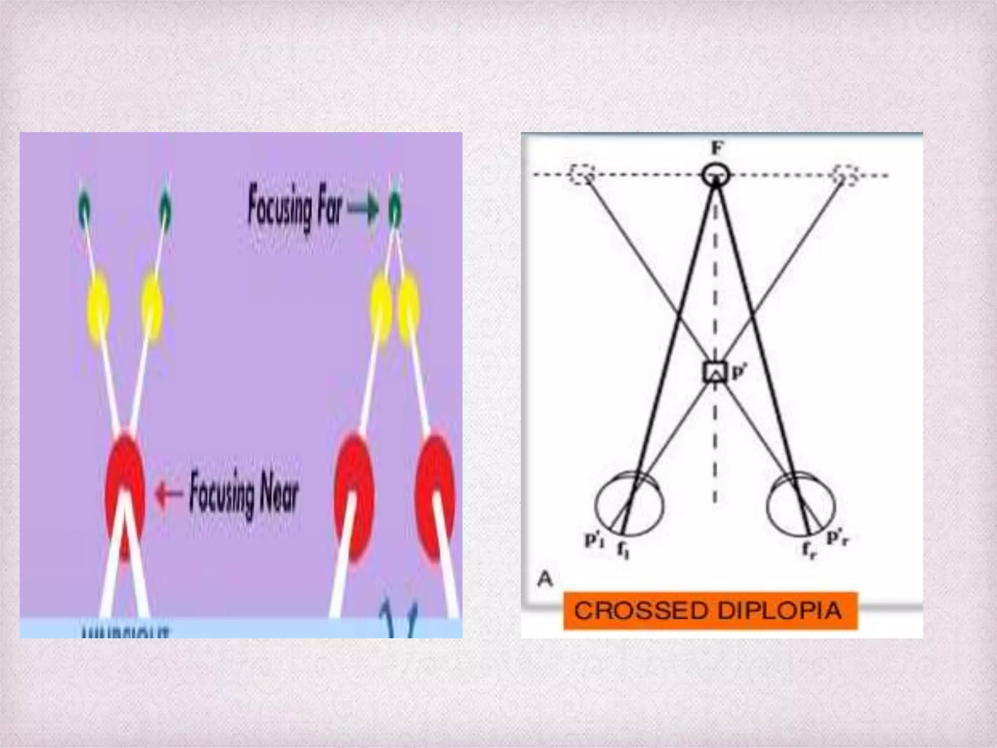 Treatment Strategies for Routine Binocular Vision Problems | PPTX