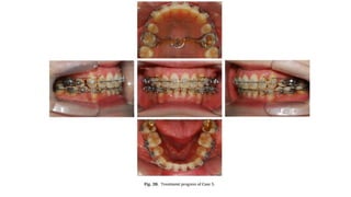 Treatment strategies for vertical maxillary excess.pptx