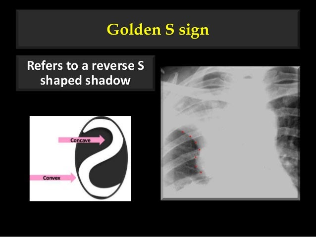 Tree in-bud sign golden s sign