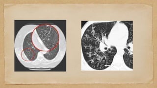 Tree in bud by dr.ameya Kulkarni DNB medicine | PPTX | Lung and ...