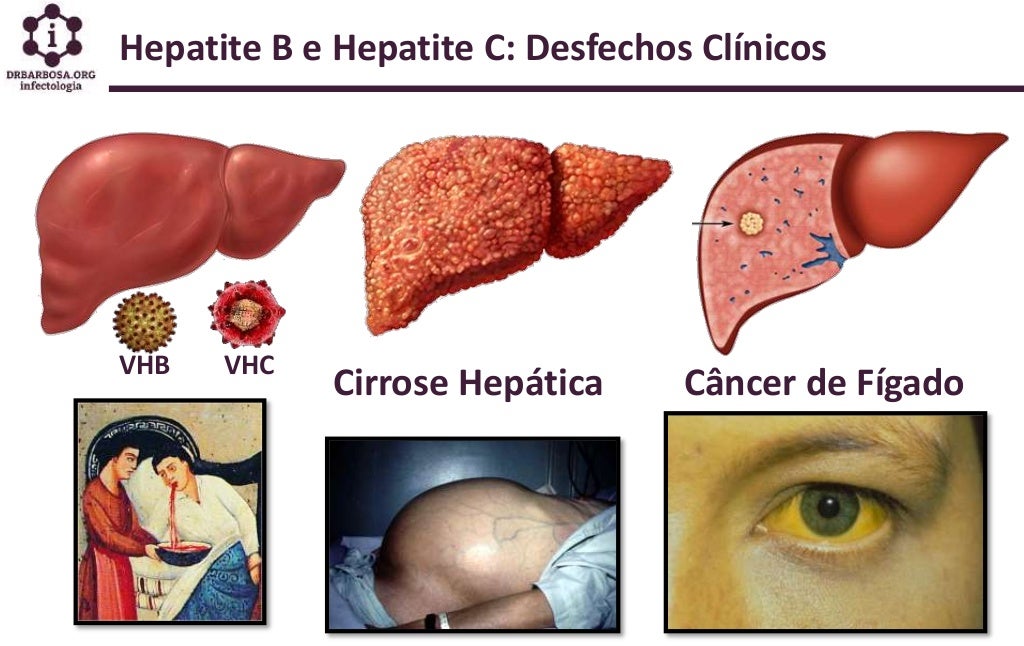 Hepatite B e Hepatite C O Básico e as Novidades em 2018