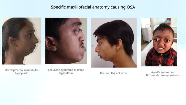 Trends in skeletal surgeries for OSA.pptx