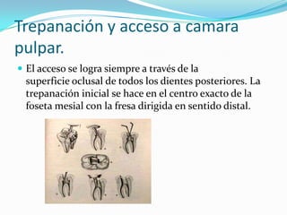 Trepanación y acceso a cámara pulpar | PPTX