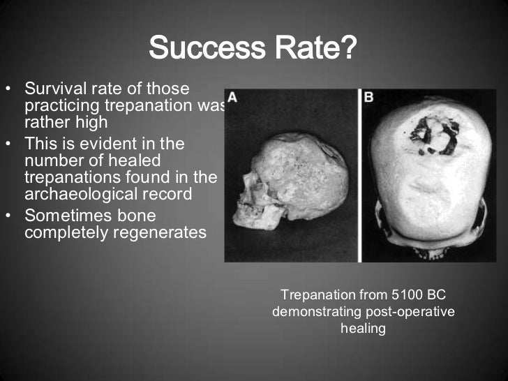 Trepanation Presentation by Karrah Christenson Session 8 2012