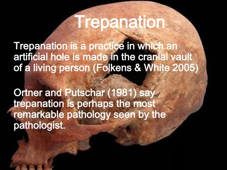 Trepanation Presentation by Karrah Christenson Session 8 2012
