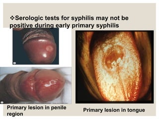Treponema pallidum and syphilis | PPT