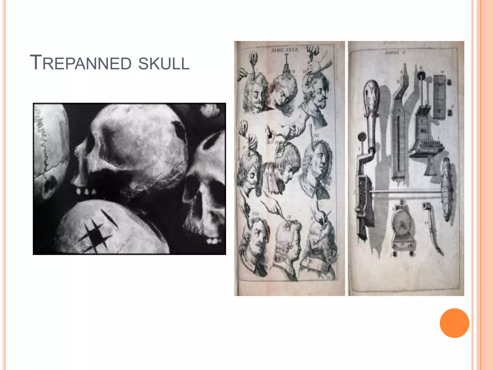 Treppanned skull | PPTX