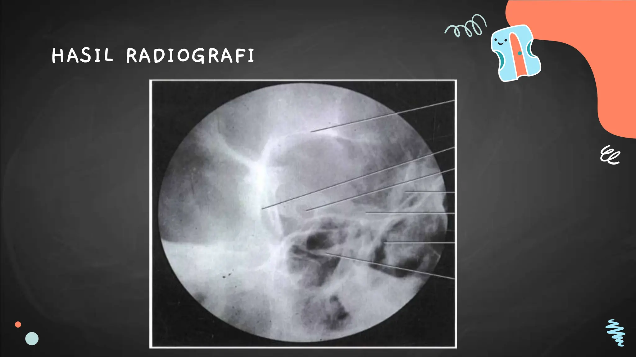 Teknik Radiografi Dasar FORAMEN OPTICUM.pptx