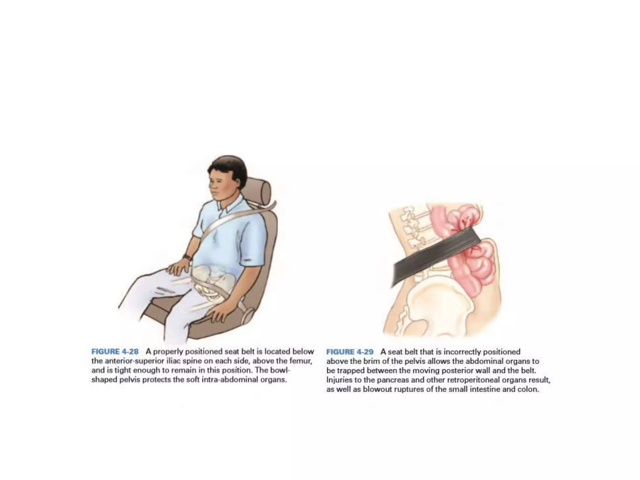 Triage &assesment of abdominal trauma | PPTX
