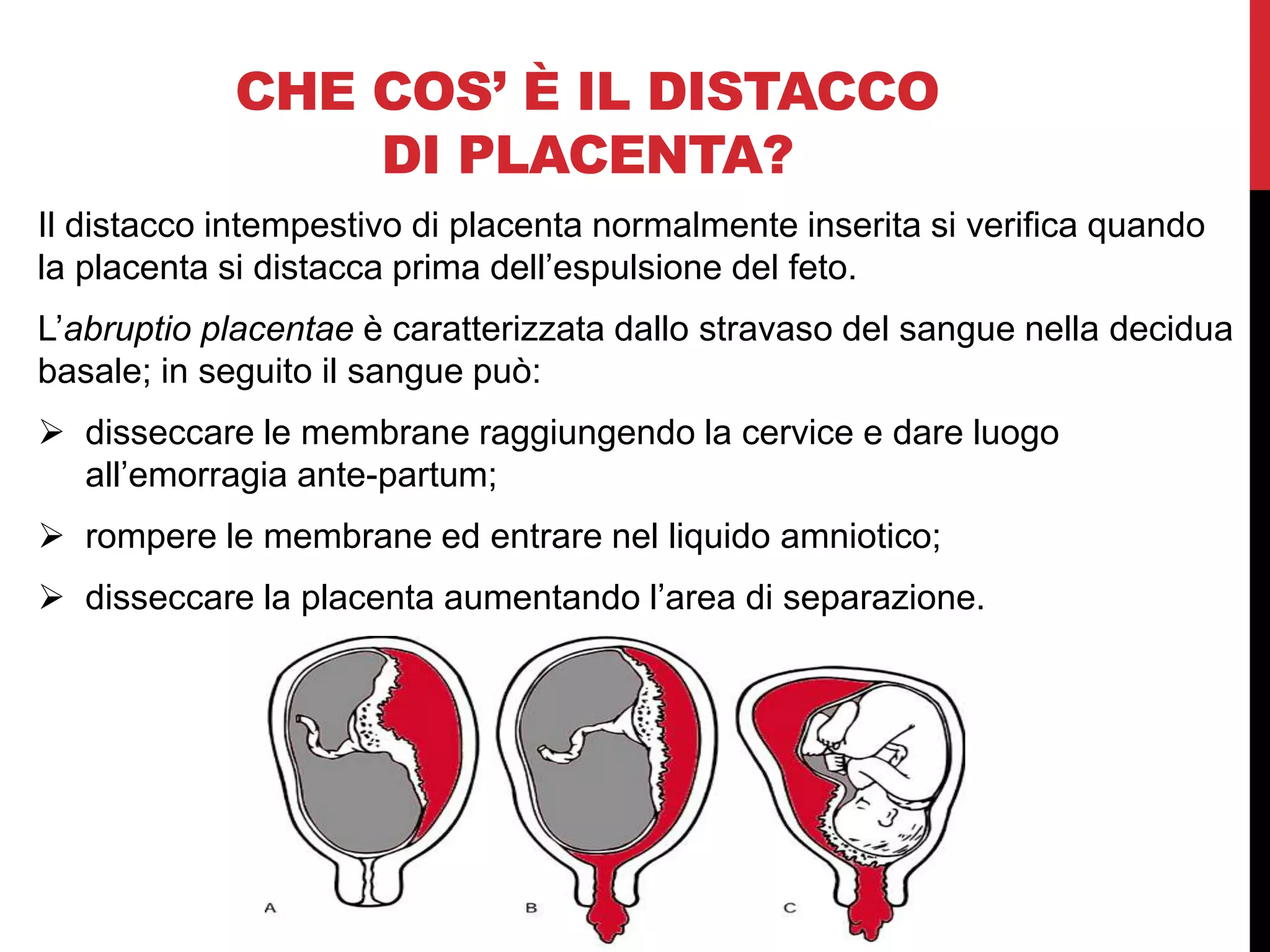 Triage ostetrico ed emorragia peripartum | PPTX