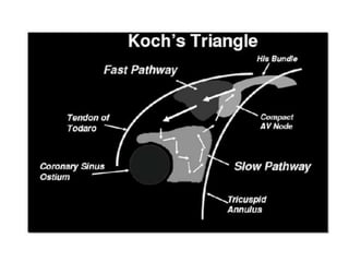 Triangle of koch | PPTX