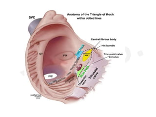 Triangle of koch | PPT