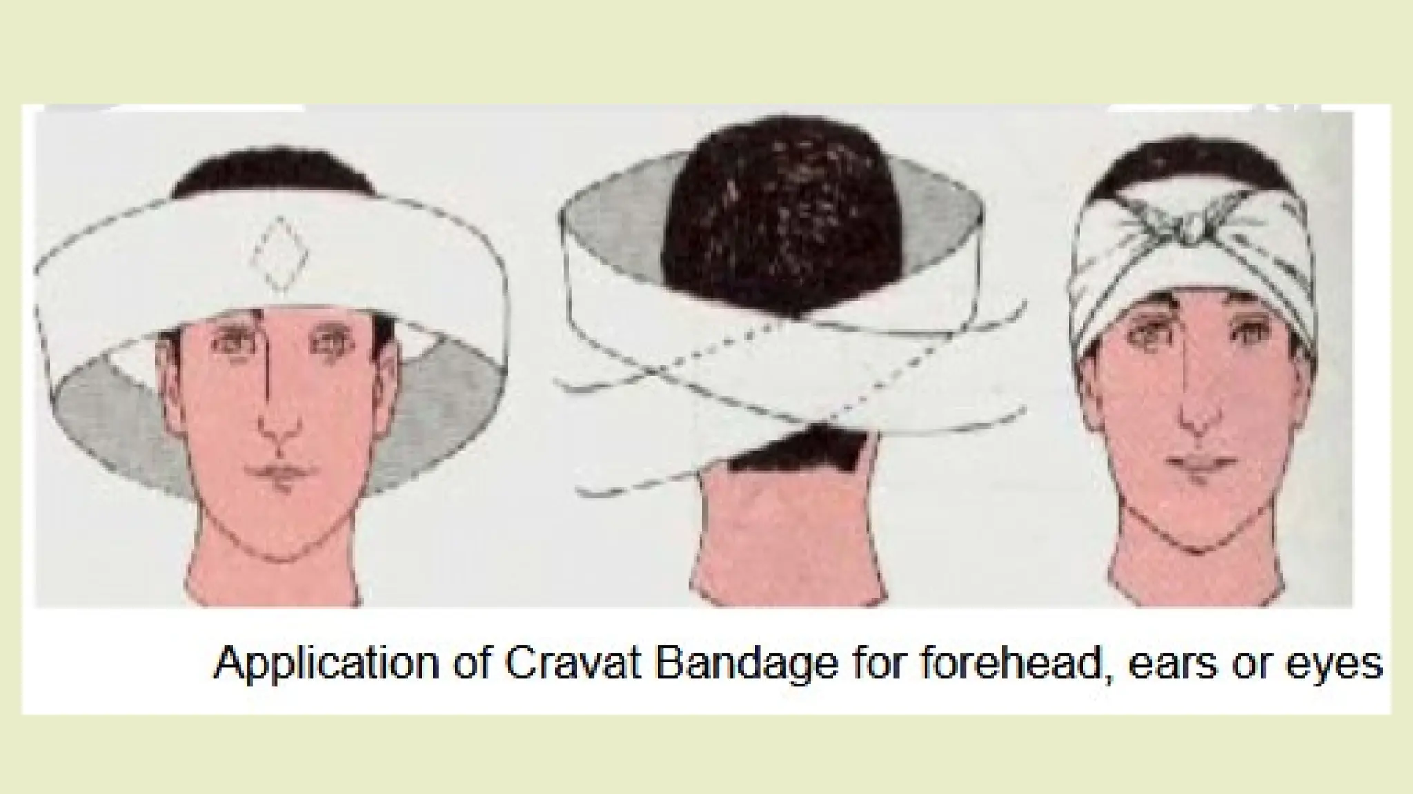 Proper Application of Triangular Bandage during Disaster | PPTX