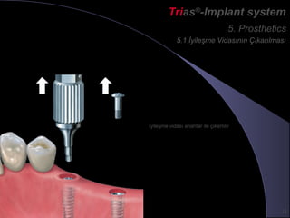Trias implant system | PPT