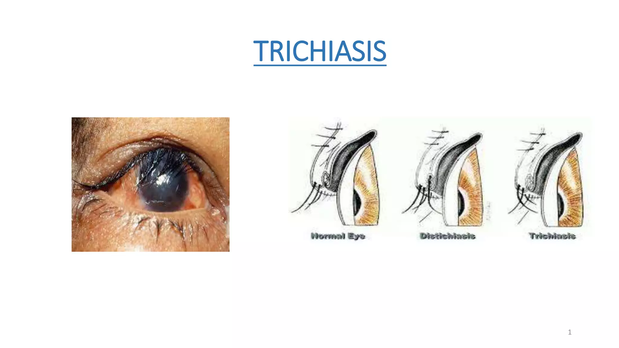 Trichiasis | PPTX