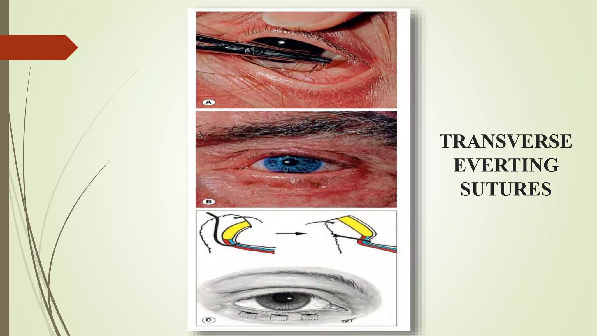 Trichiasis entropion | PPTX