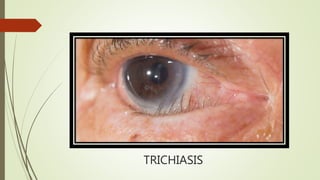 Trichiasis entropion | PPTX | Eye and Vision Conditions | Diseases and ...