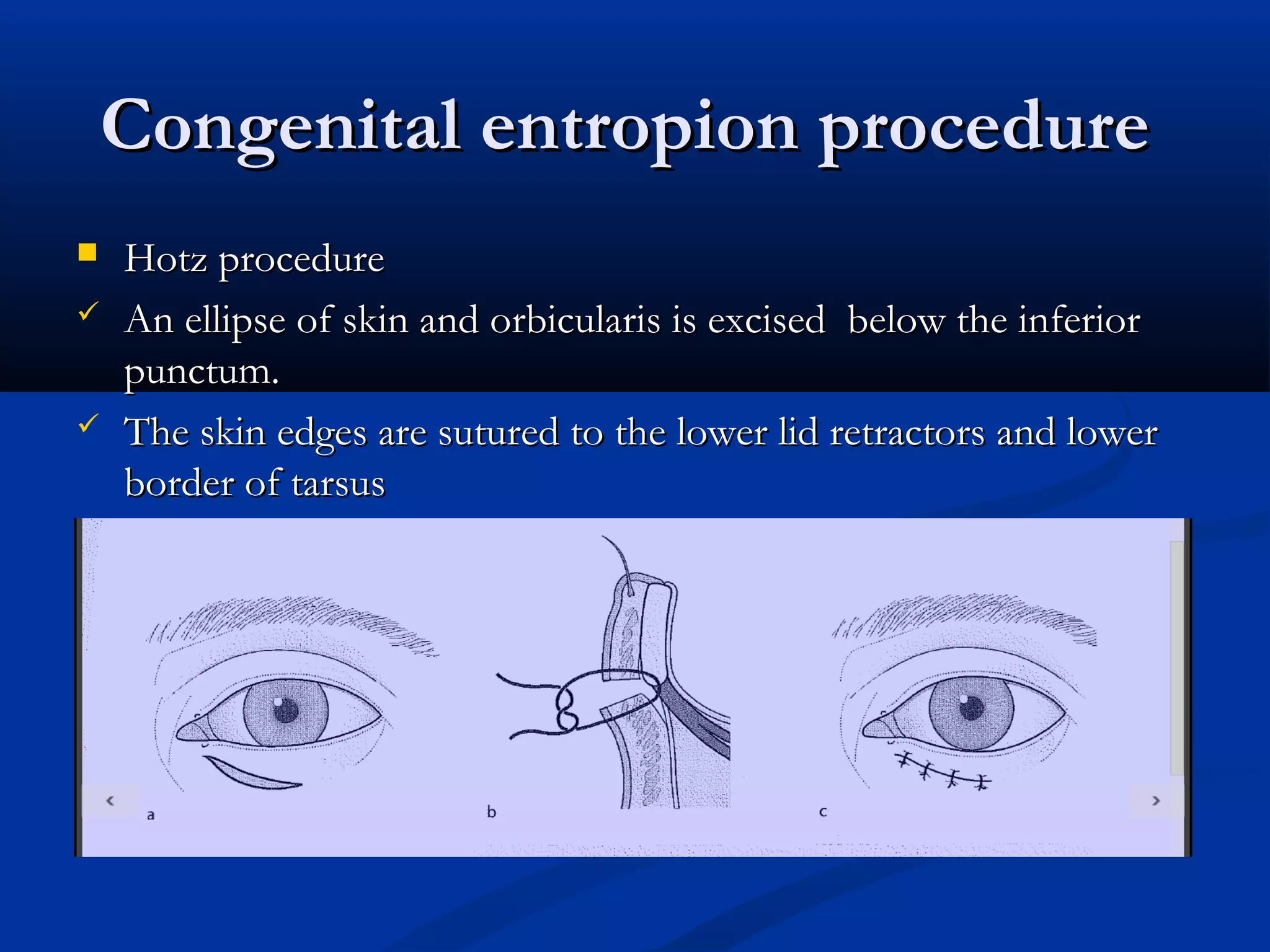 Ectropion and entropion | PPT