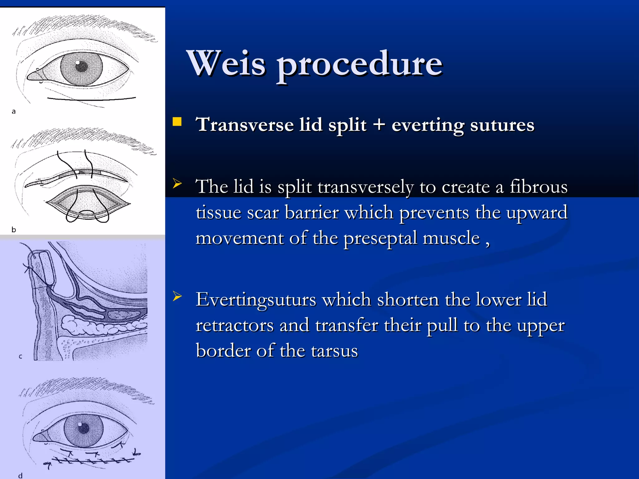 Ectropion and entropion | PPT