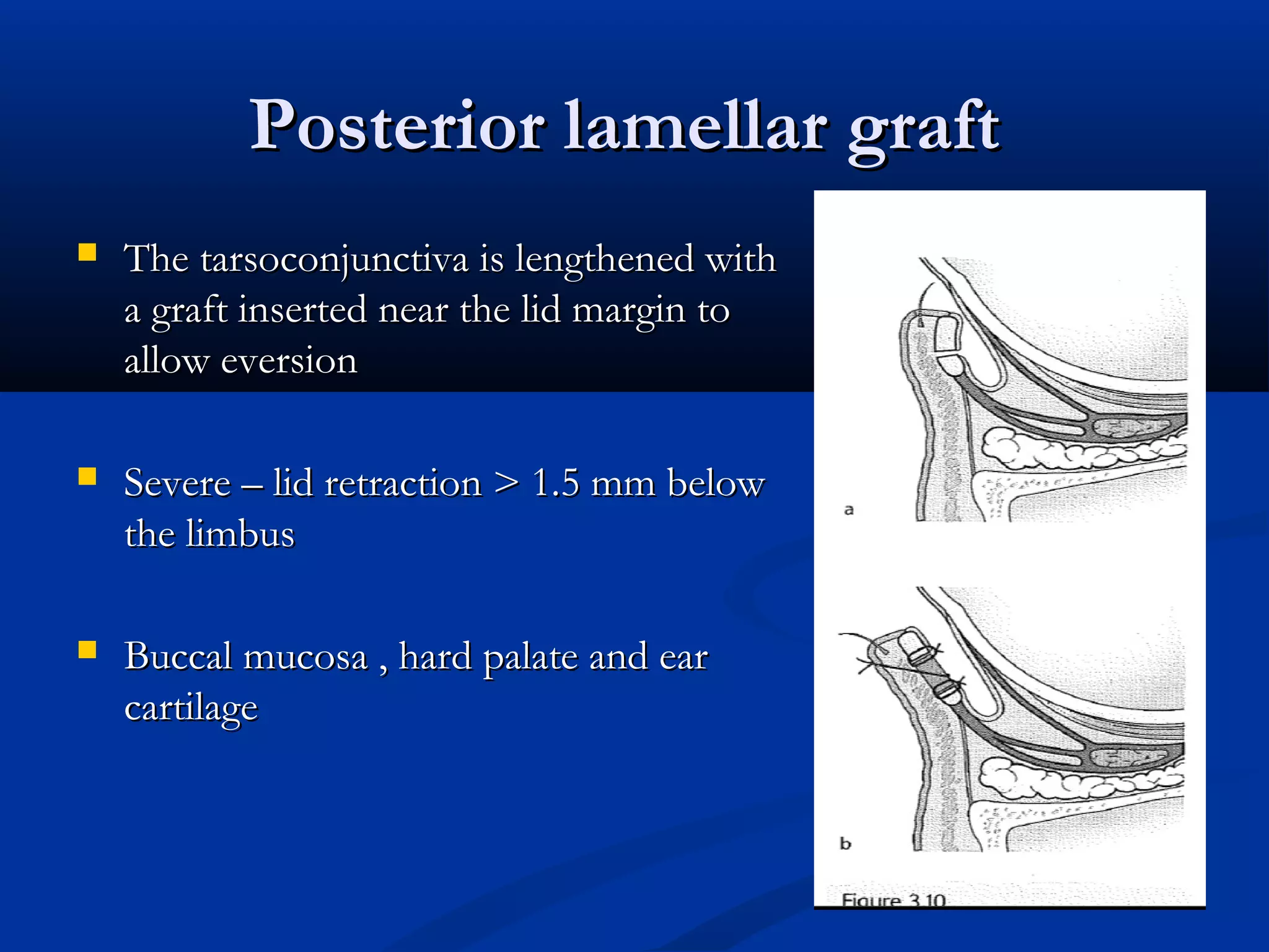 Ectropion and entropion | PPT