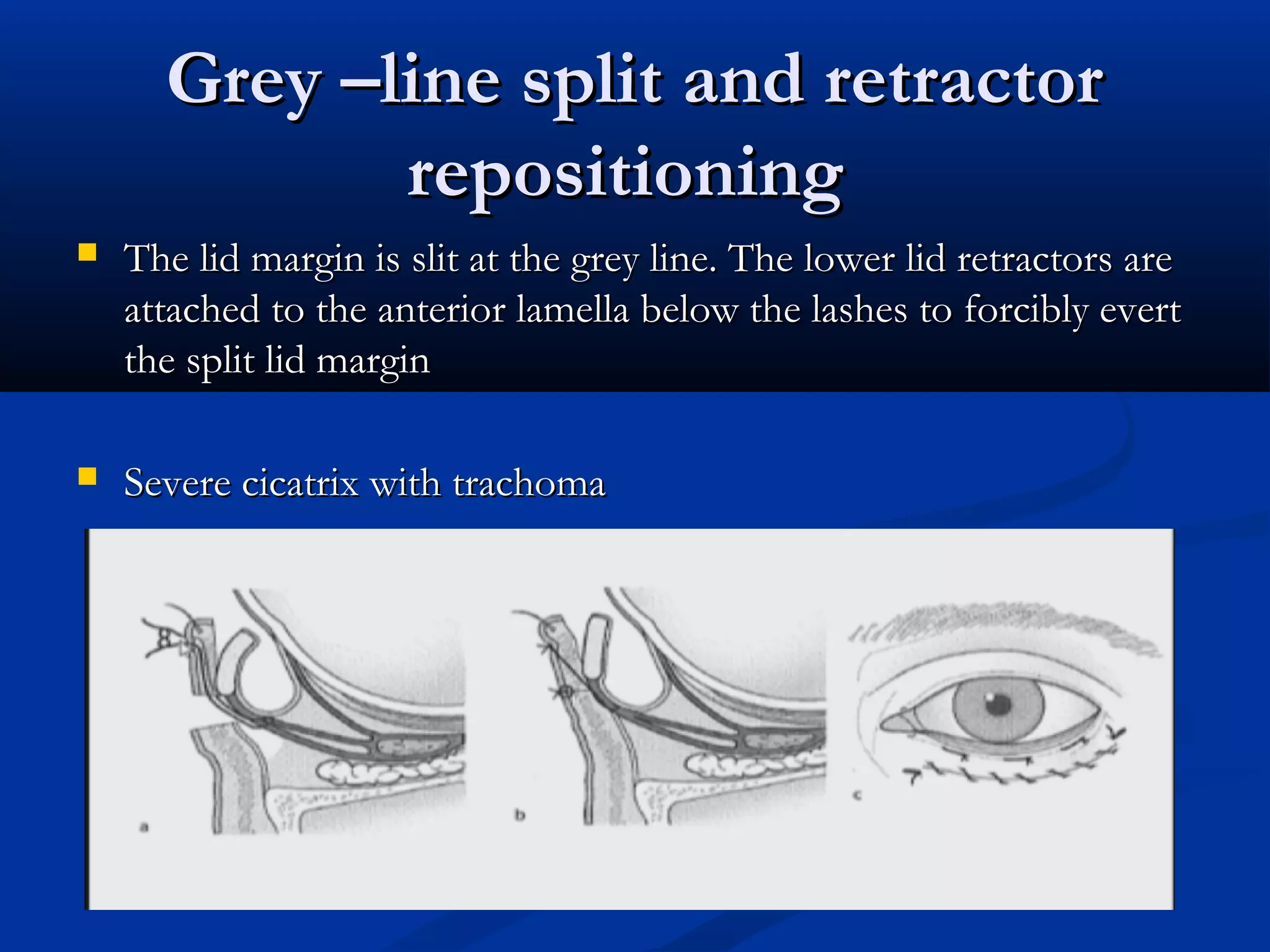 Ectropion and entropion | PPT
