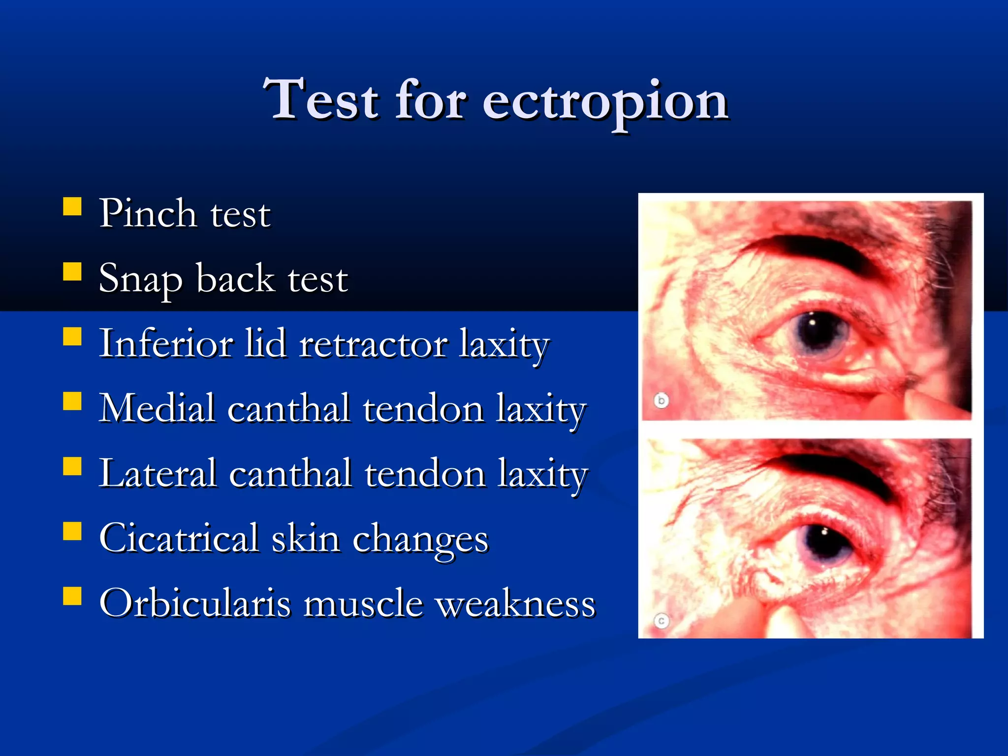 Ectropion and entropion | PPT