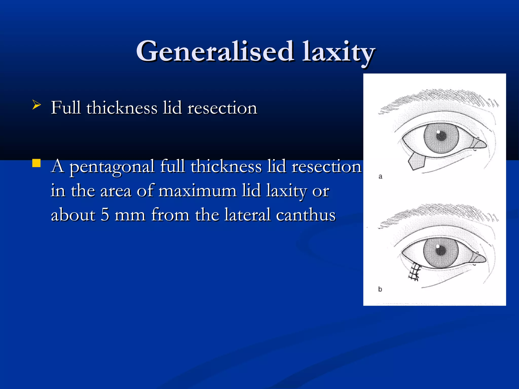 Ectropion and entropion | PPT