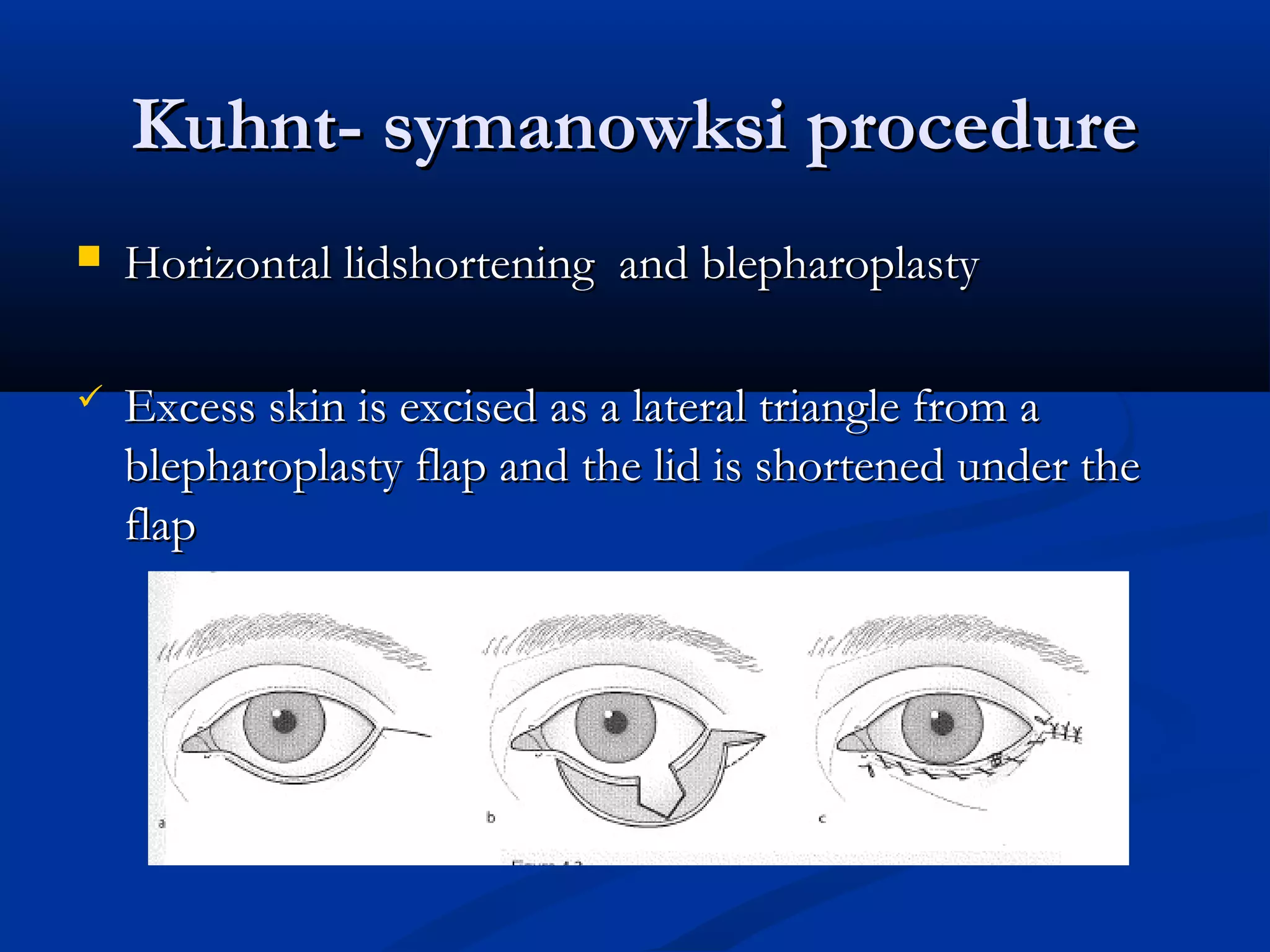 Ectropion and entropion | PPT