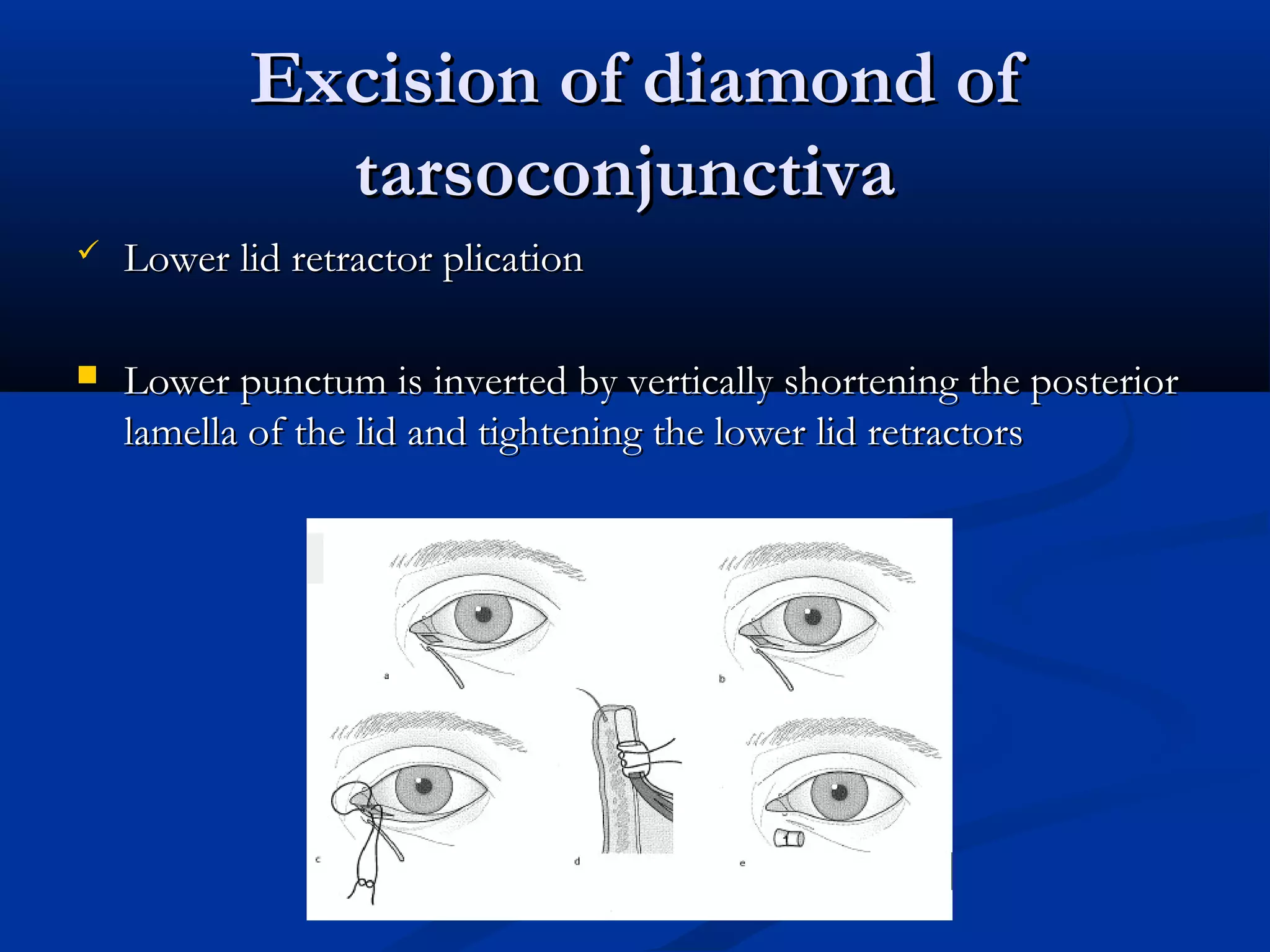 Ectropion and entropion | PPT