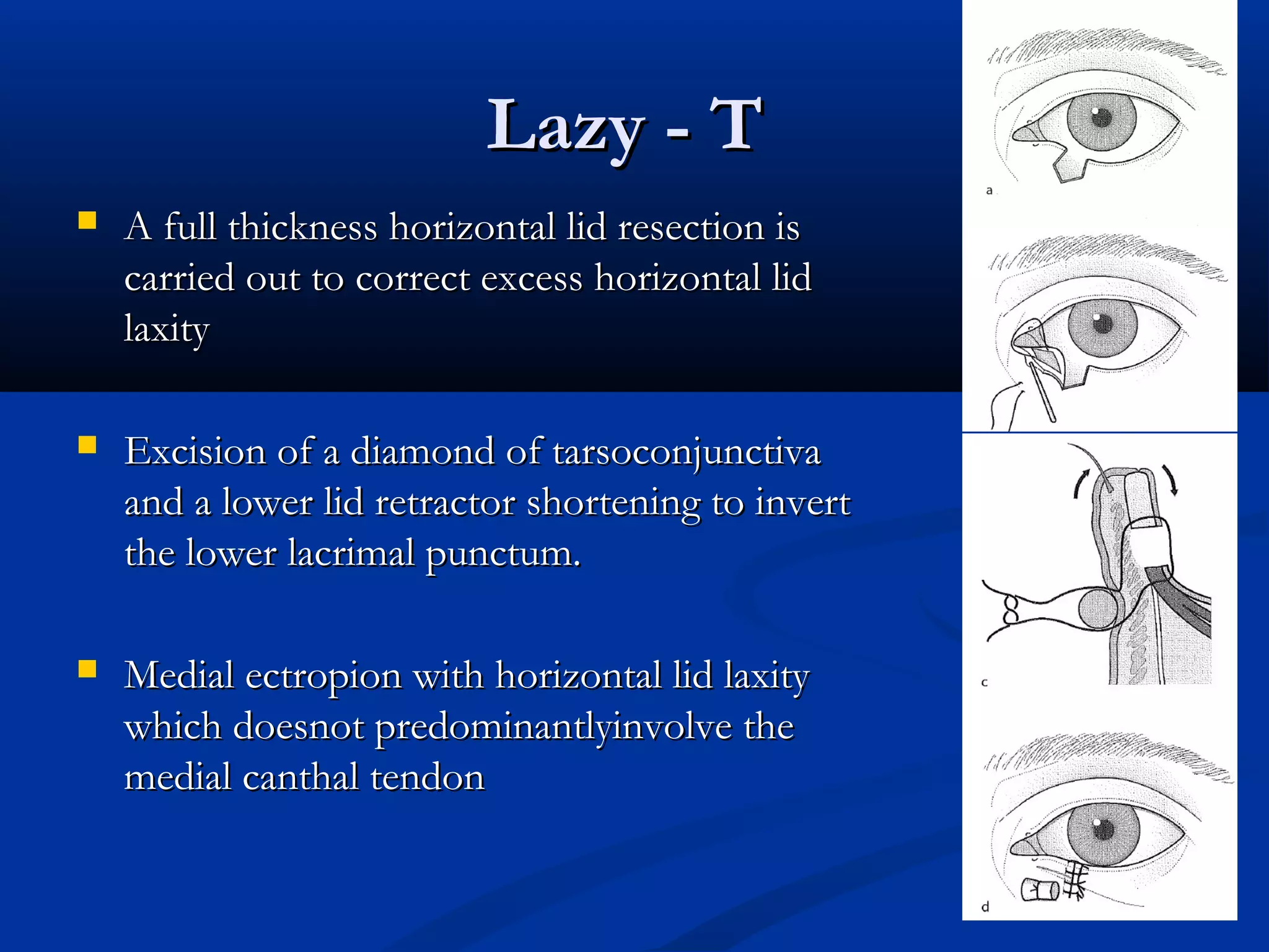 Ectropion and entropion | PPT