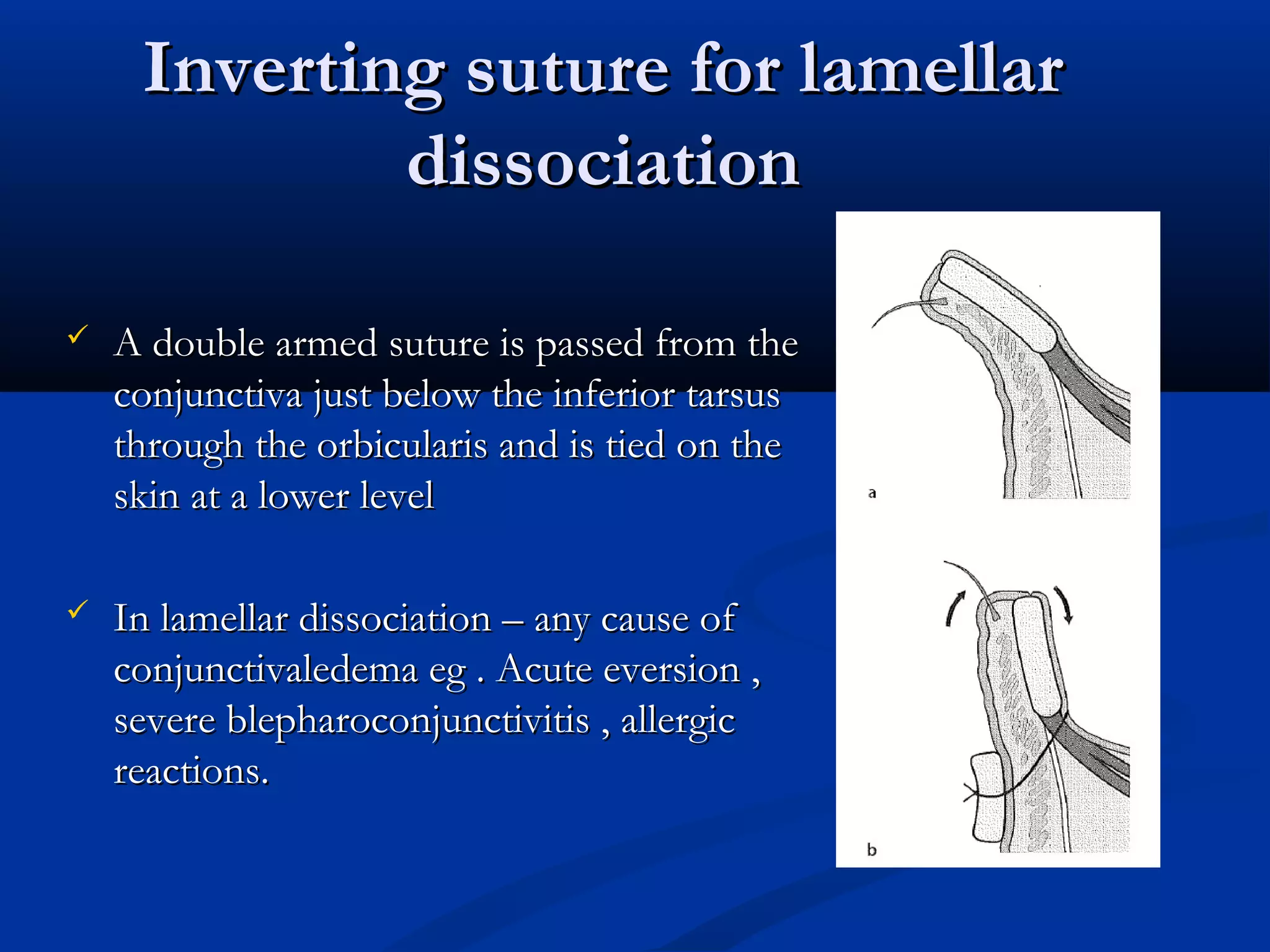Ectropion and entropion | PPT