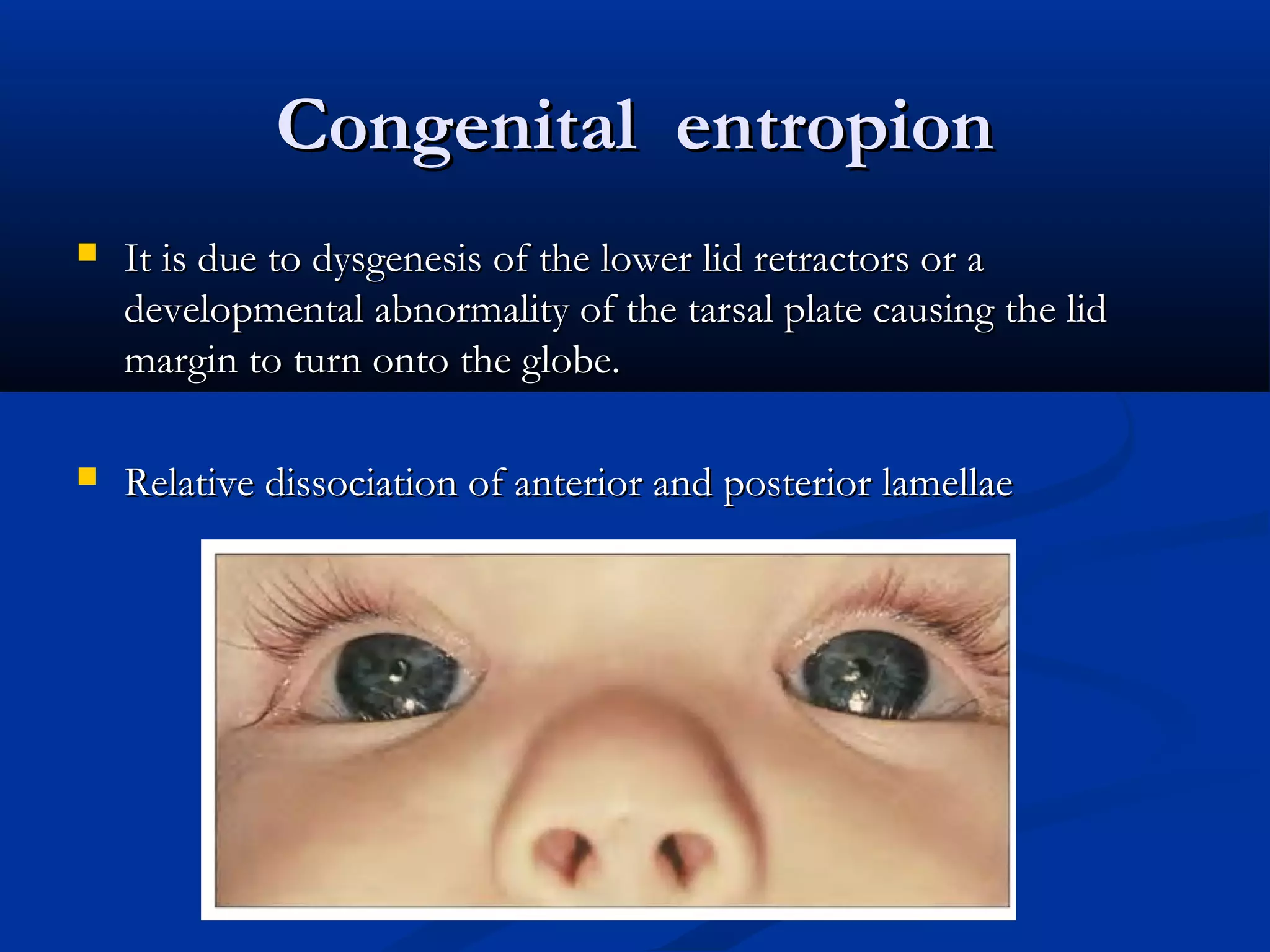 Ectropion and entropion | PPT