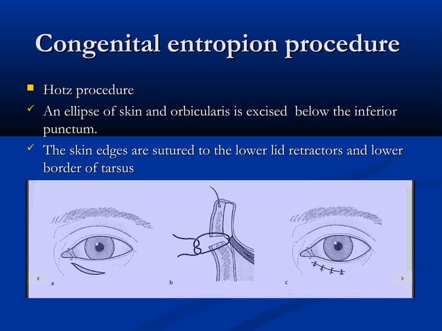 Ectropion and entropion | PPT