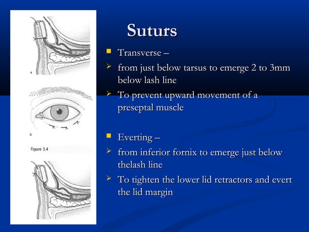 Ectropion and entropion | PPT