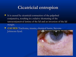 Ectropion and entropion | PPT