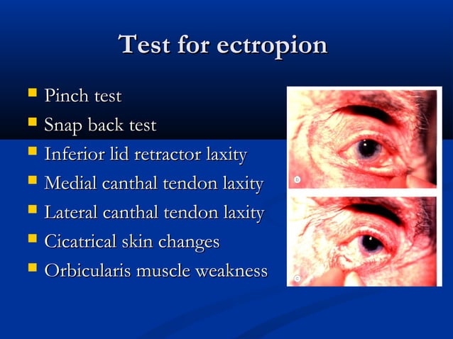 Ectropion and entropion | PPT | Free Download