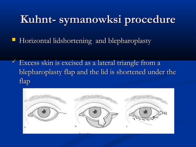 Ectropion and entropion | PPT