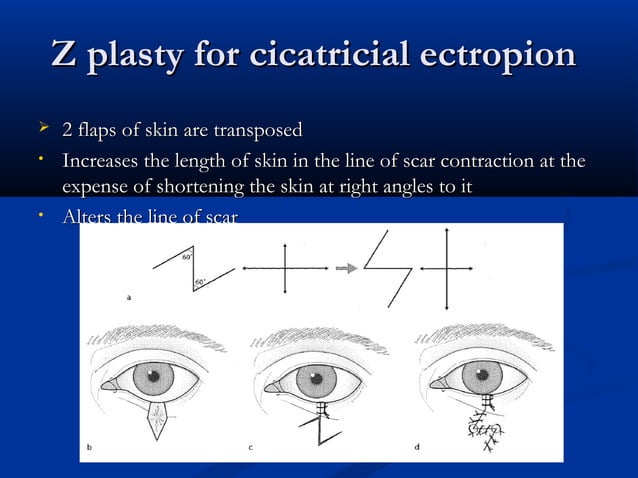 Ectropion and entropion | PPT