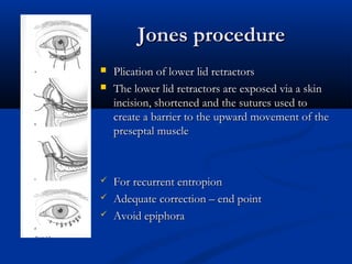 Ectropion and entropion | PPT