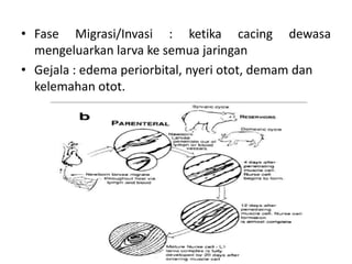 Trichinella spiralis | PPTX