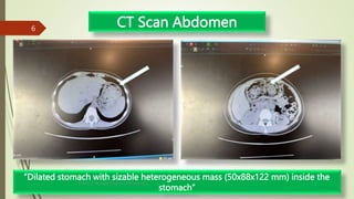 A case of Trichobezoar in a teenage female | PPTX