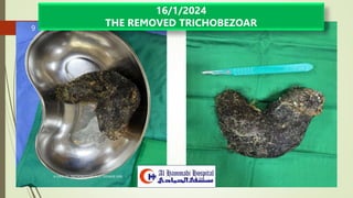 A case of Trichobezoar in a teenage female | PPTX