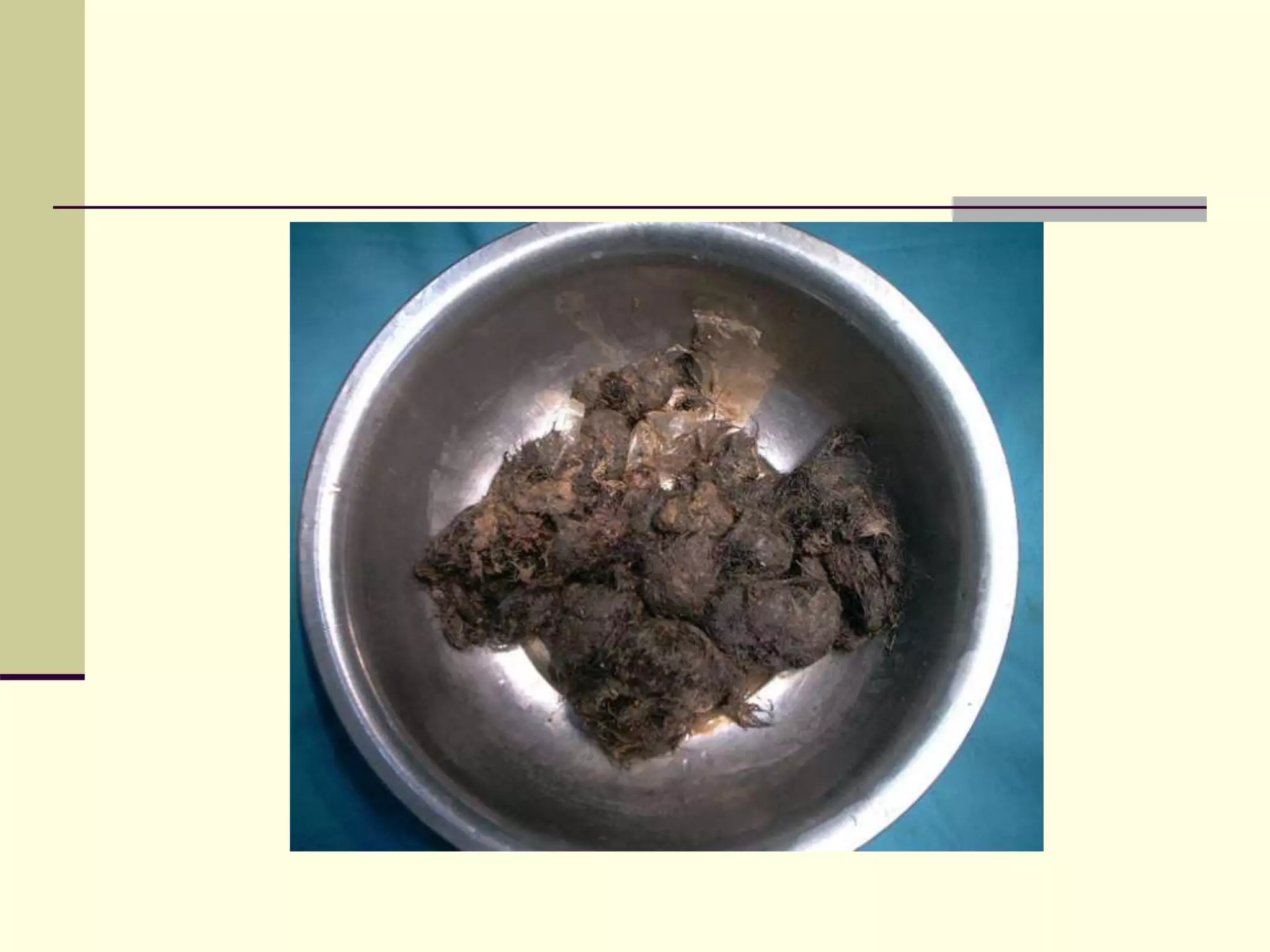 Trichobezoar management - laparoscopic | PPT