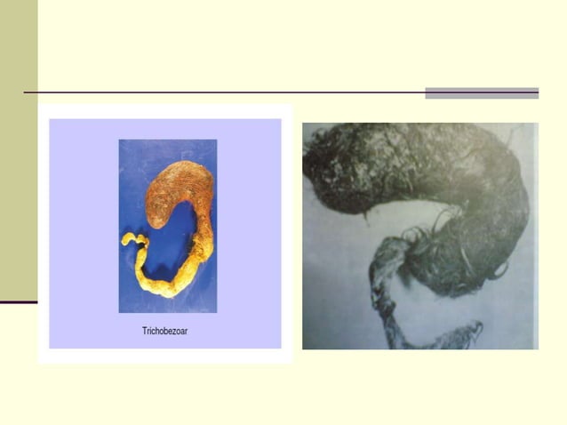 Trichobezoar management - laparoscopic | PPT