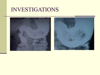 Trichobezoar management - laparoscopic | PPT