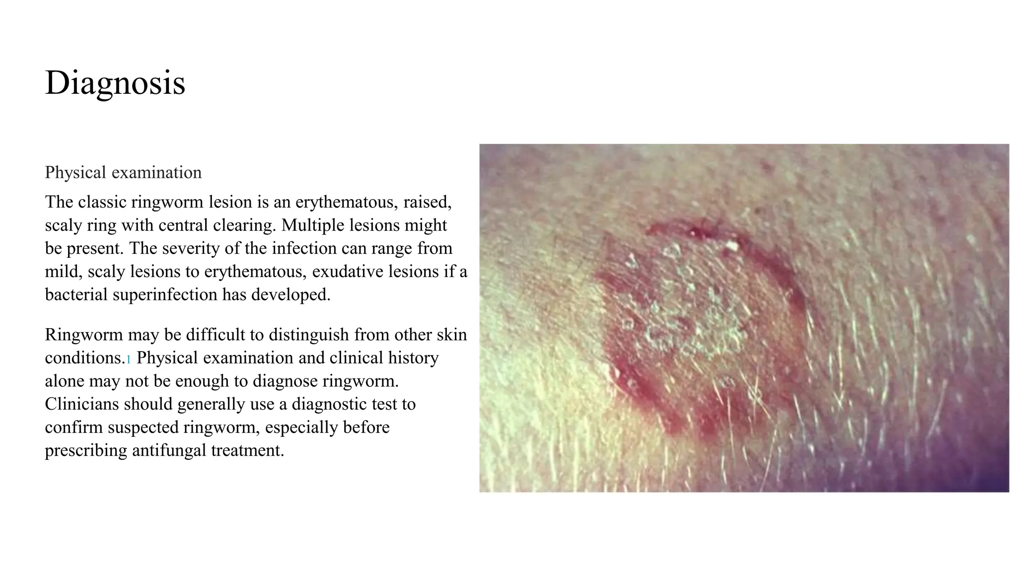Trichophytia Dermatophytosis. Onerbek Almaz.pptx