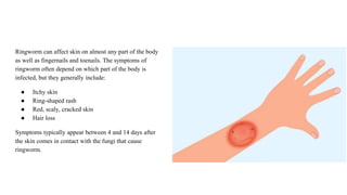 Trichophytia Dermatophytosis. Onerbek Almaz.pptx