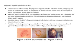 Trichophytia Dermatophytosis. Onerbek Almaz.pptx