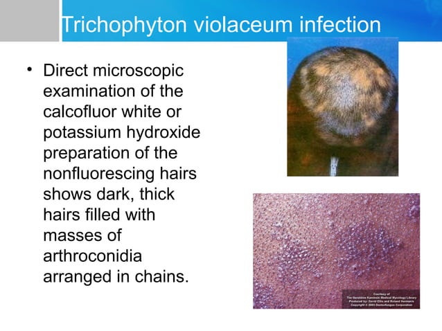 Trichophyton and Epidermophyton | PPT | Skin and Dermatology | Diseases ...