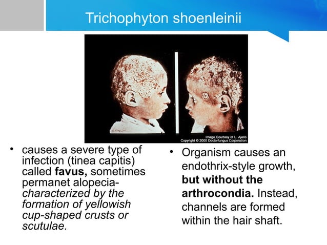 Trichophyton and Epidermophyton | PPT | Skin and Dermatology | Diseases ...